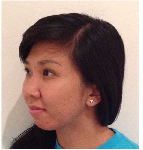 Dermal Treatments – skin alive