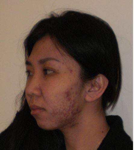 Dermal Treatments – skin alive